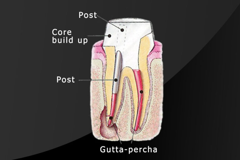 Post and Core Dental Treatment | Tru Dental Charlotte