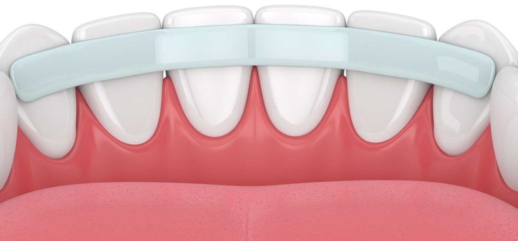 Periodontal Splinting Services | Tru Dental Charlotte